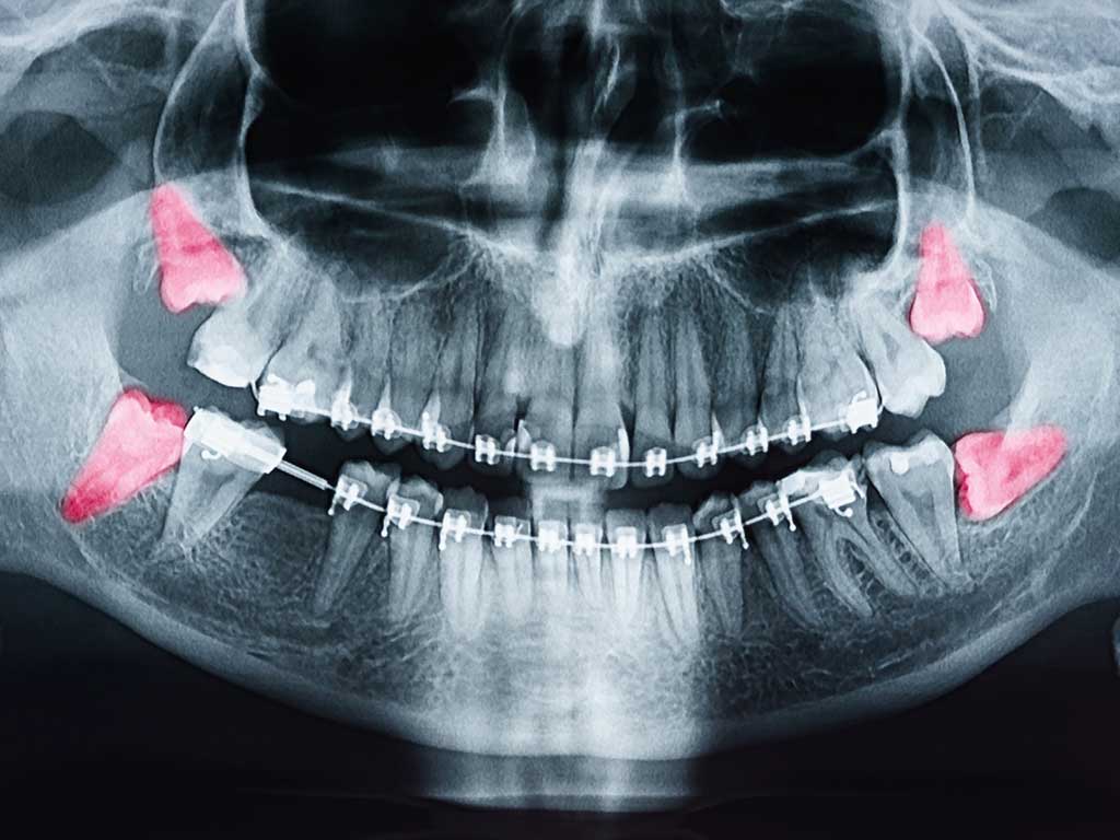 Post-Wisdom Teeth Extraction Care: Recovery Guidelines - Portland Oral ...