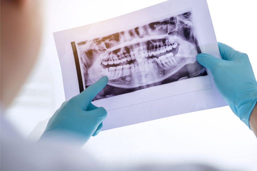Replacing a Bridge with an Implant: Why it’s the most common "upgrade ...